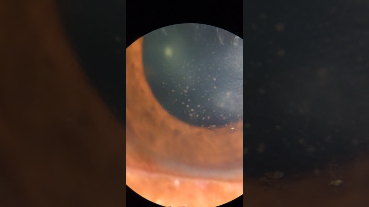 Mutton fat Keratitic Precipitates - YouTube