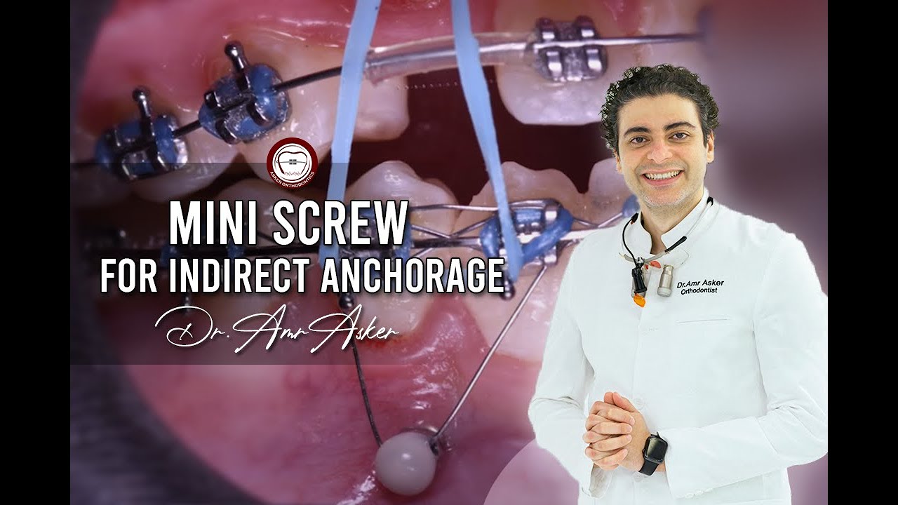 Mini screw indirect anchorage for upper canine extrusion and canting ...