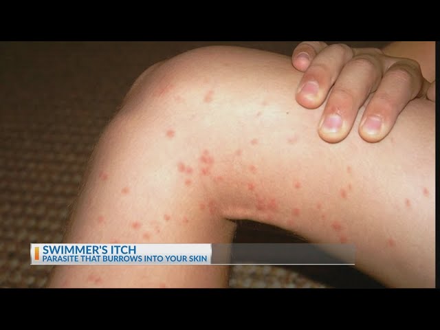 Swimmer's Itch Rash