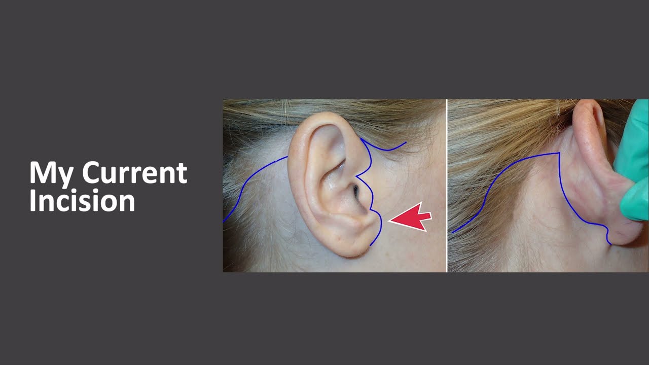 Face & Neck Lift Pearls: Incisions & SMAS Management - YouTube