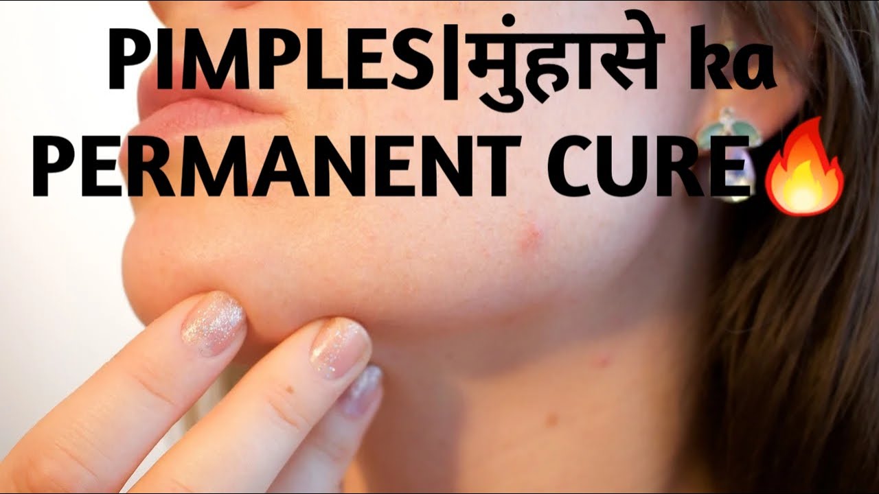 PIMPLE|मुंहासे KA PERMANENT CURE - YouTube