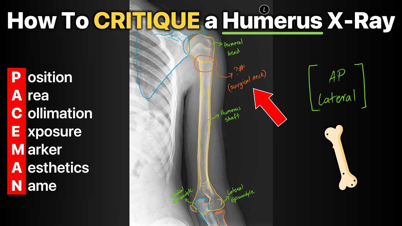 How To Critique a Humerus X-Ray! - YouTube