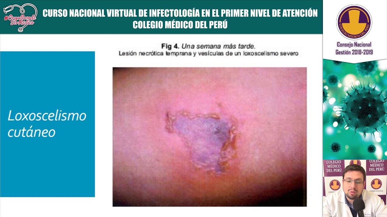 Modulo I - clase 07: Aracnoidismo - Dr. Alfredo Chiappe González - YouTube