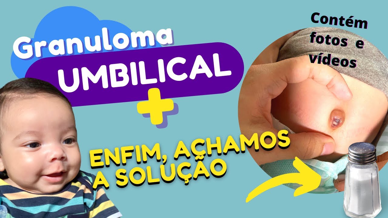 Granuloma De Coto Umbilical - RETOEDU