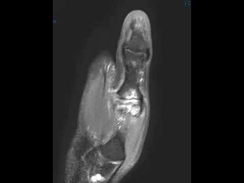 UCL tear thumb and Stener lesion