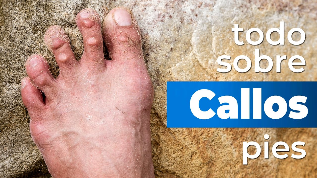 ¿Que es la Hiperqueratosis? Todo sobre los callos - YouTube