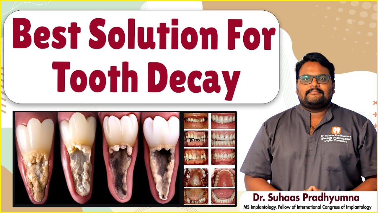 Best Solution For Tooth Decay || Root Canal Treatment || Dr. Suhaas ...