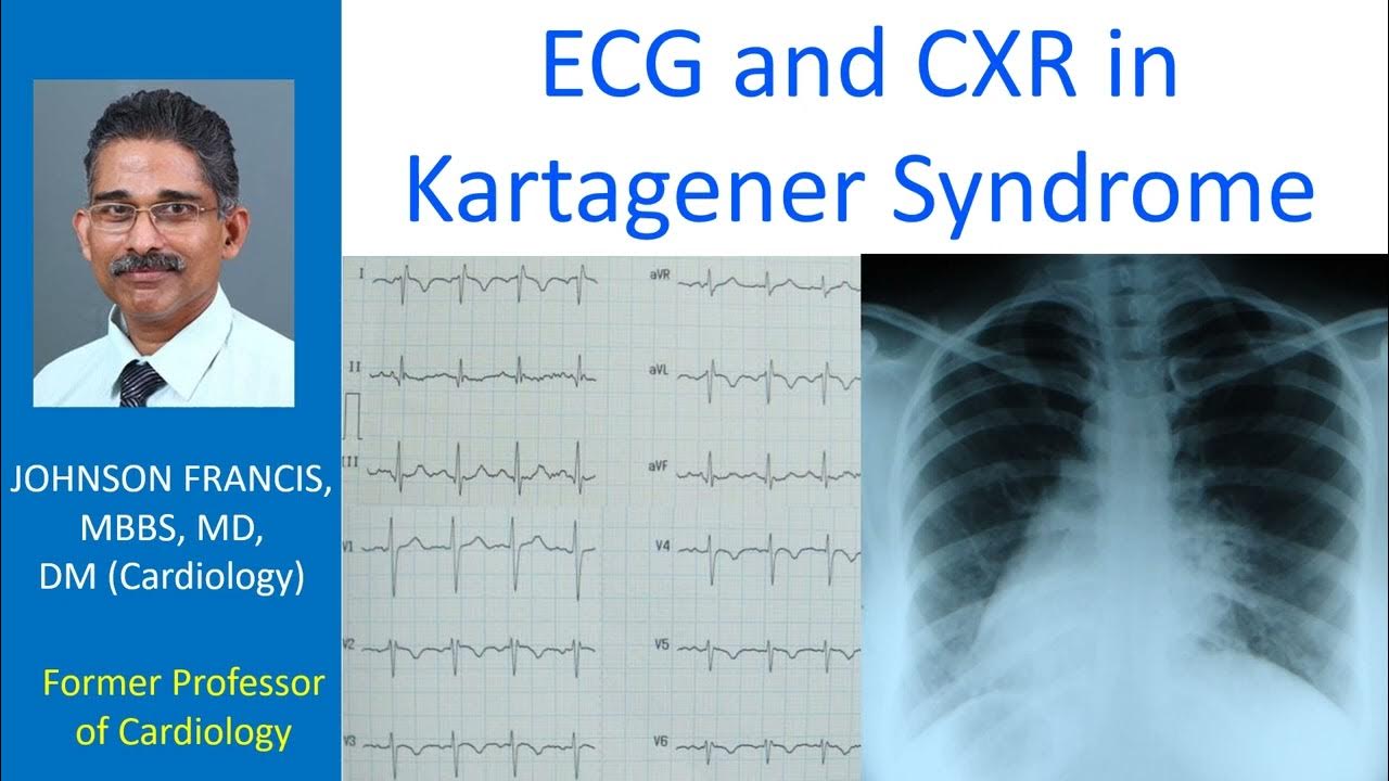 ECG And CXR In Kartagener Syndrome YouTube ecg-and-cxr-in-kartagener-syndrome-youtube