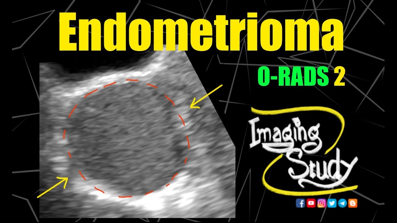Chocolate Cyst Ultrasound At Jennie Wilson Blog