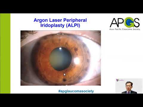 Angle Closure Management - A Logical Approach Based on Angle Closure Type and Mechanisms
