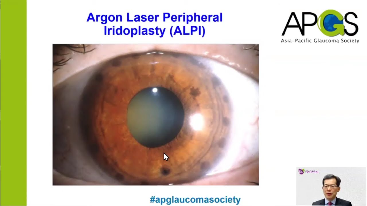 Angle Closure Management - A Logical Approach Based on Angle Closure ...