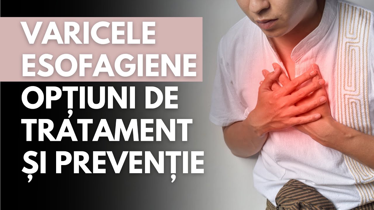 Varicele Esofagiene - Opțiuni de tratament și prevenție cu Dr. Cristian ...