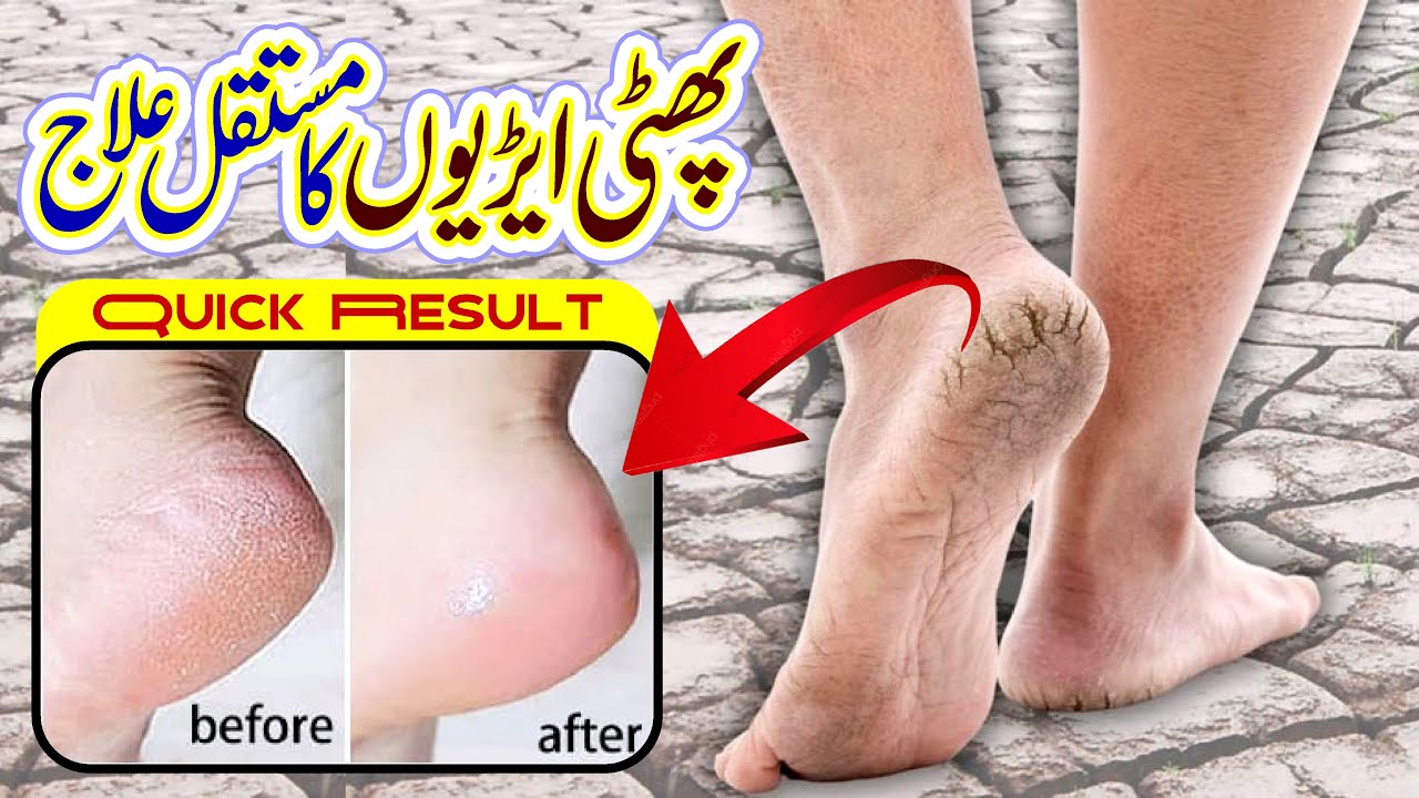 cracked heels treatment | phati erian / dry heel permanent treatment ...