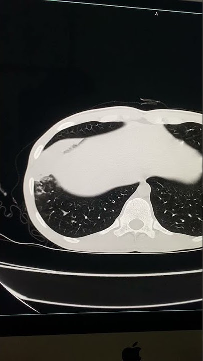 Tree in bud nodules - TB - YouTube