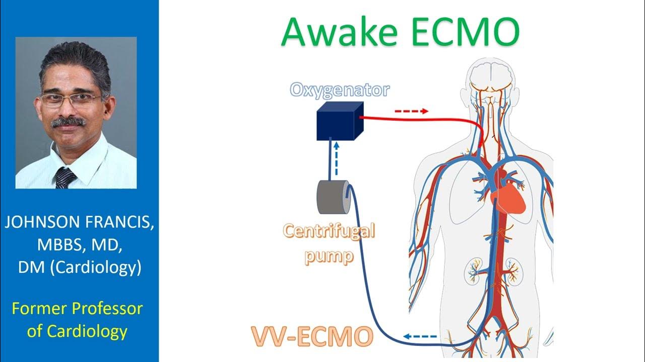 Awake ECMO - YouTube