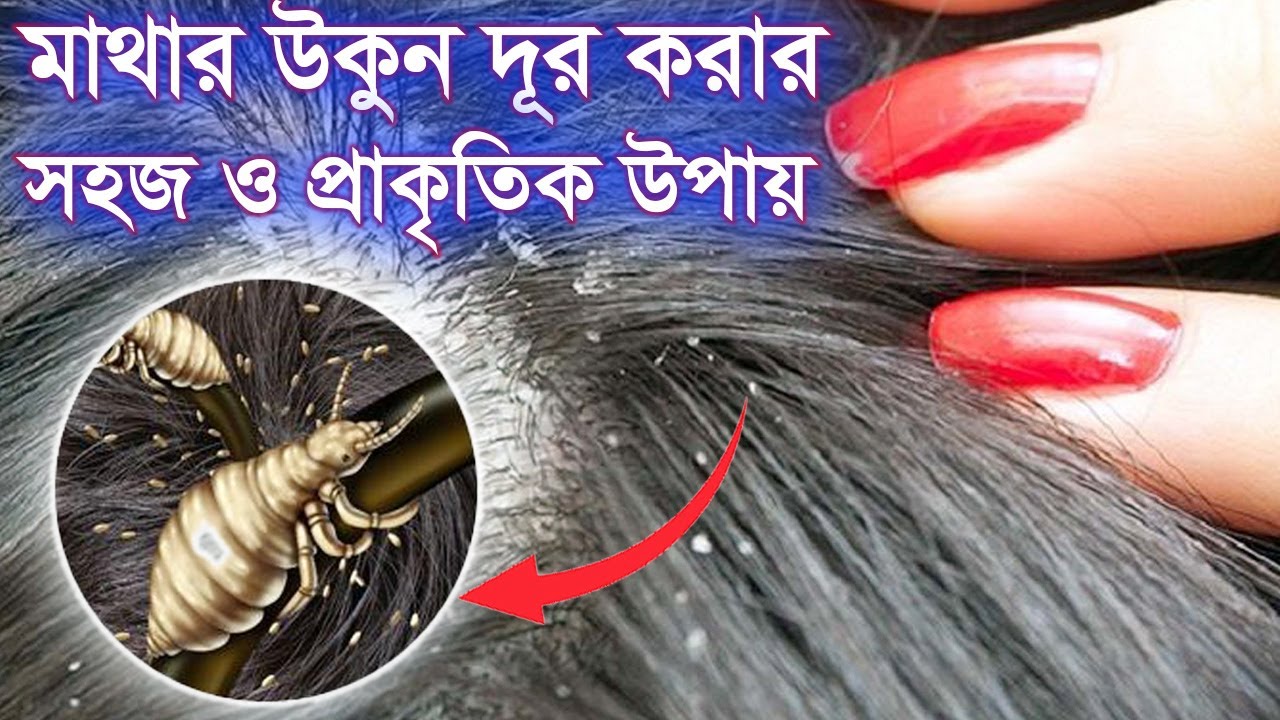 মাথার উকুন ও লিকি দূর করার সহজ উপায় || Remove Lice 100% From Your Hair ...