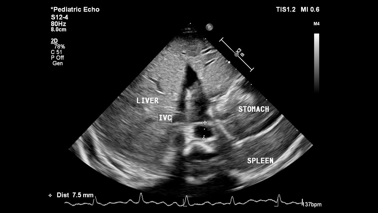 Basic echocardiography(심장 초음파 기본)- Subcostal view - YouTube