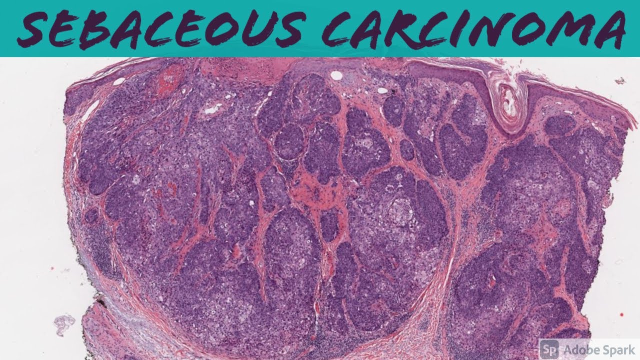 Sebaceous carcinoma: 5-Minute Pathology Pearls - YouTube