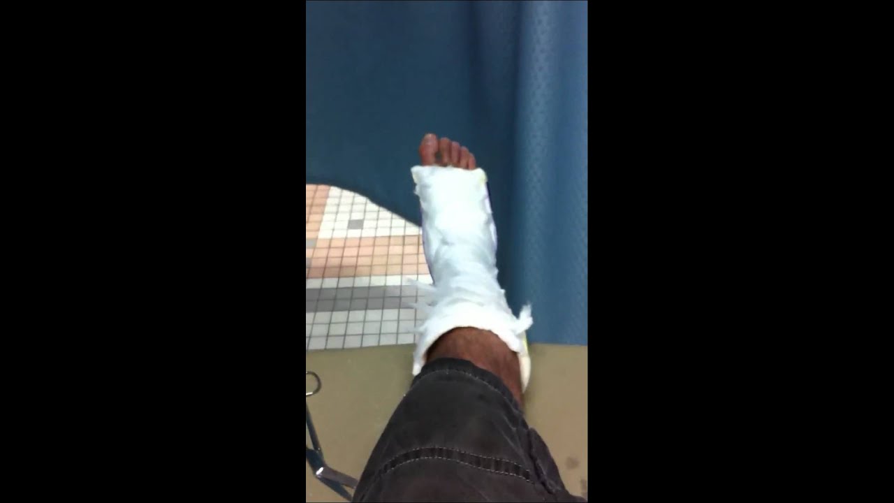 Getting my foot cast cut off - YouTube