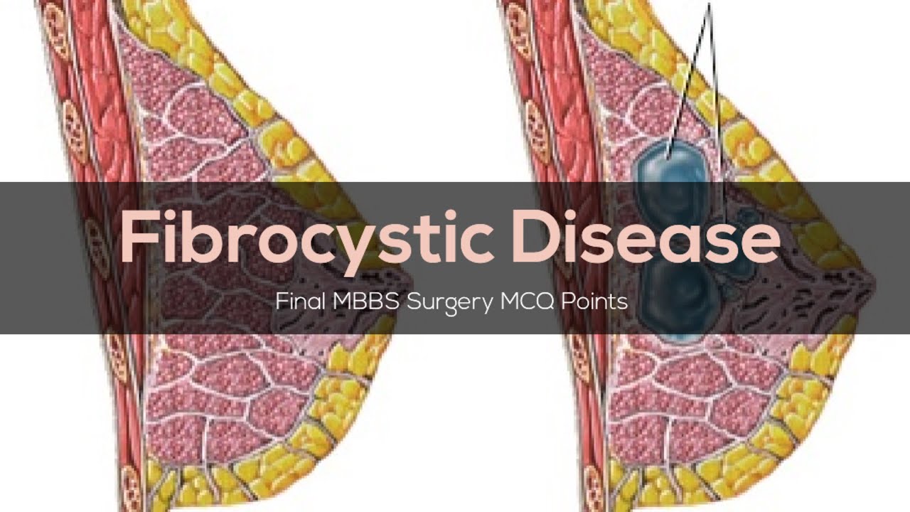 Breast Disorders 4 - Fibrocystic Disease - Final MBBS Surgery MCQ ...