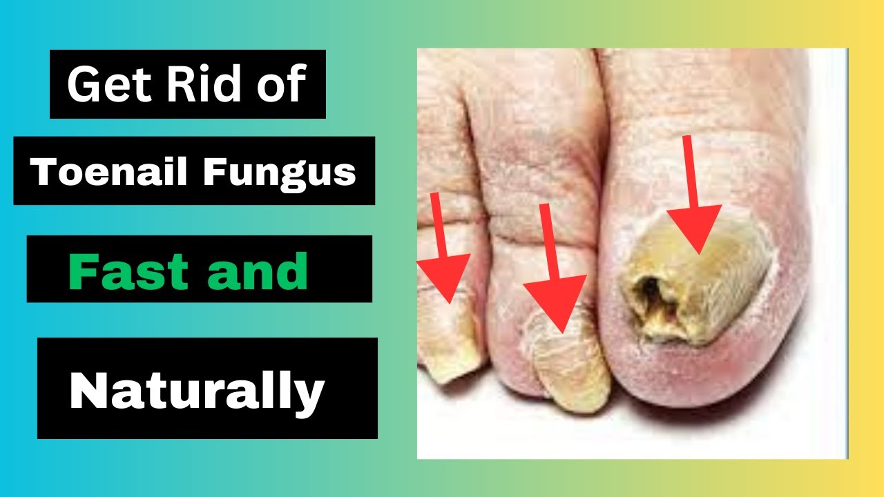 How to Get Rid of Toenail Fungus Fast and Naturally - YouTube