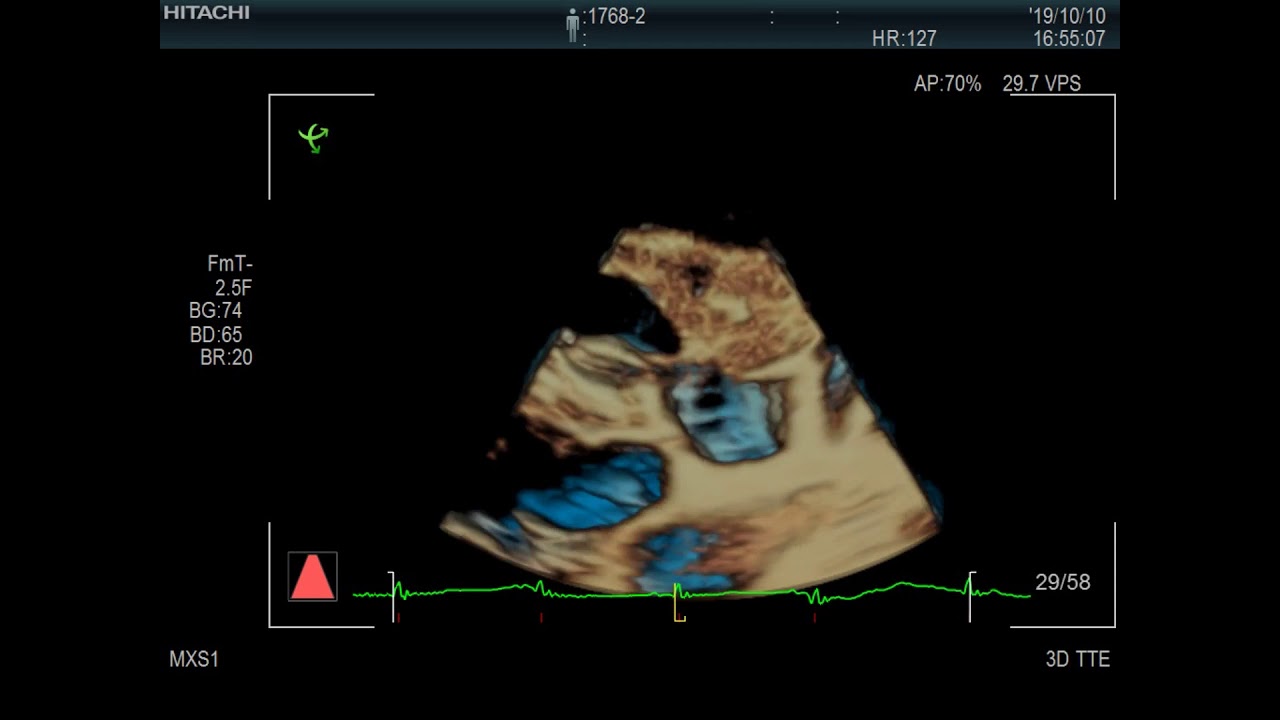 Echo image of the Cardiac tumor in a dog using 3D/4D echocardiography ...