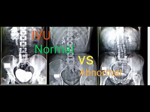 IVU !! Radiography!! Normal vs abnormal IVU. - YouTube