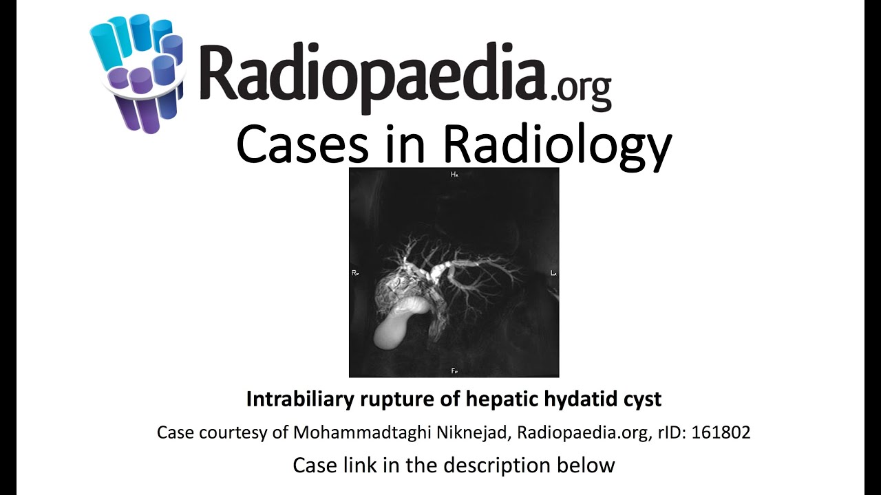 Intrabiliary rupture of hepatic hydatid cyst (Radiopaedia.org) Cases in ...