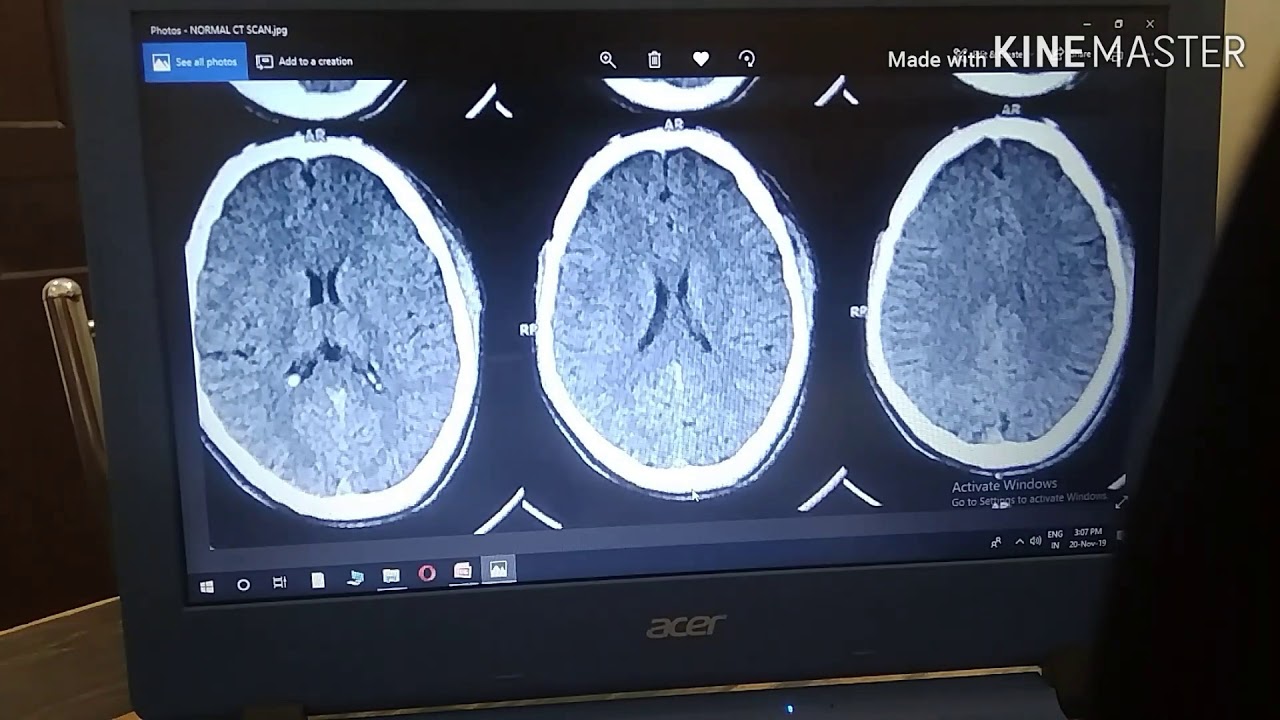How to interpretate CT SCAN BRAIN - YouTube