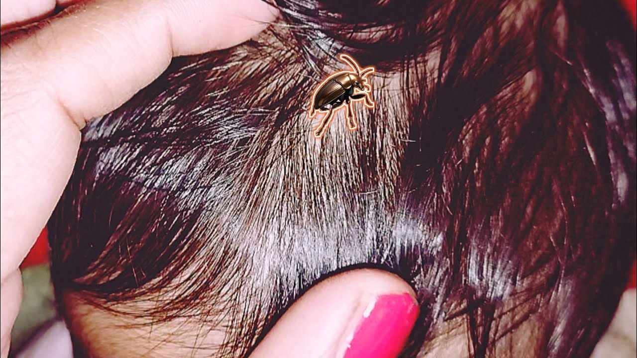 💥NEW🍼A Liceeeee 😲 is living in my🍼 Baby's Hairs🐥... #asmr #lice # ...