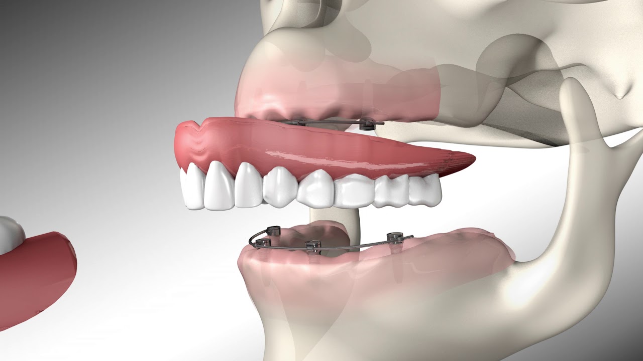 Eat and Smile with an Implant Anchored Denture from Renew - YouTube
