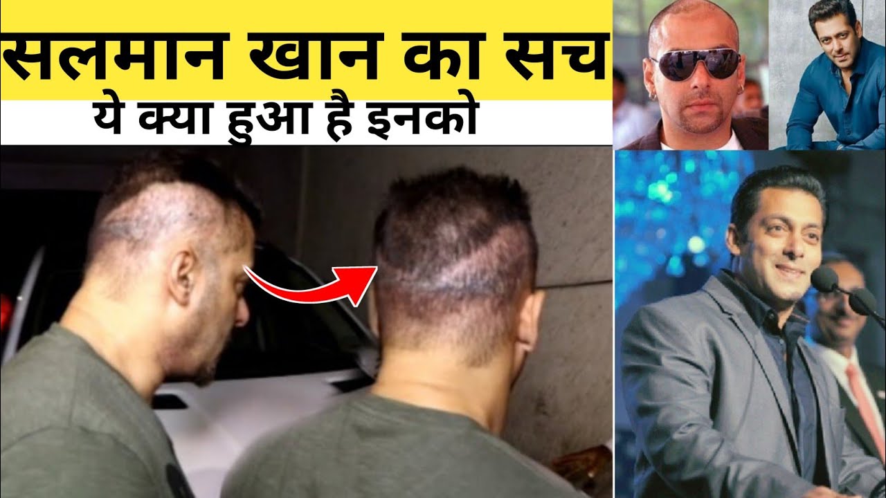 Salman khan : Hair Transplant Secret | Celebrity Hair Transplant Case ...