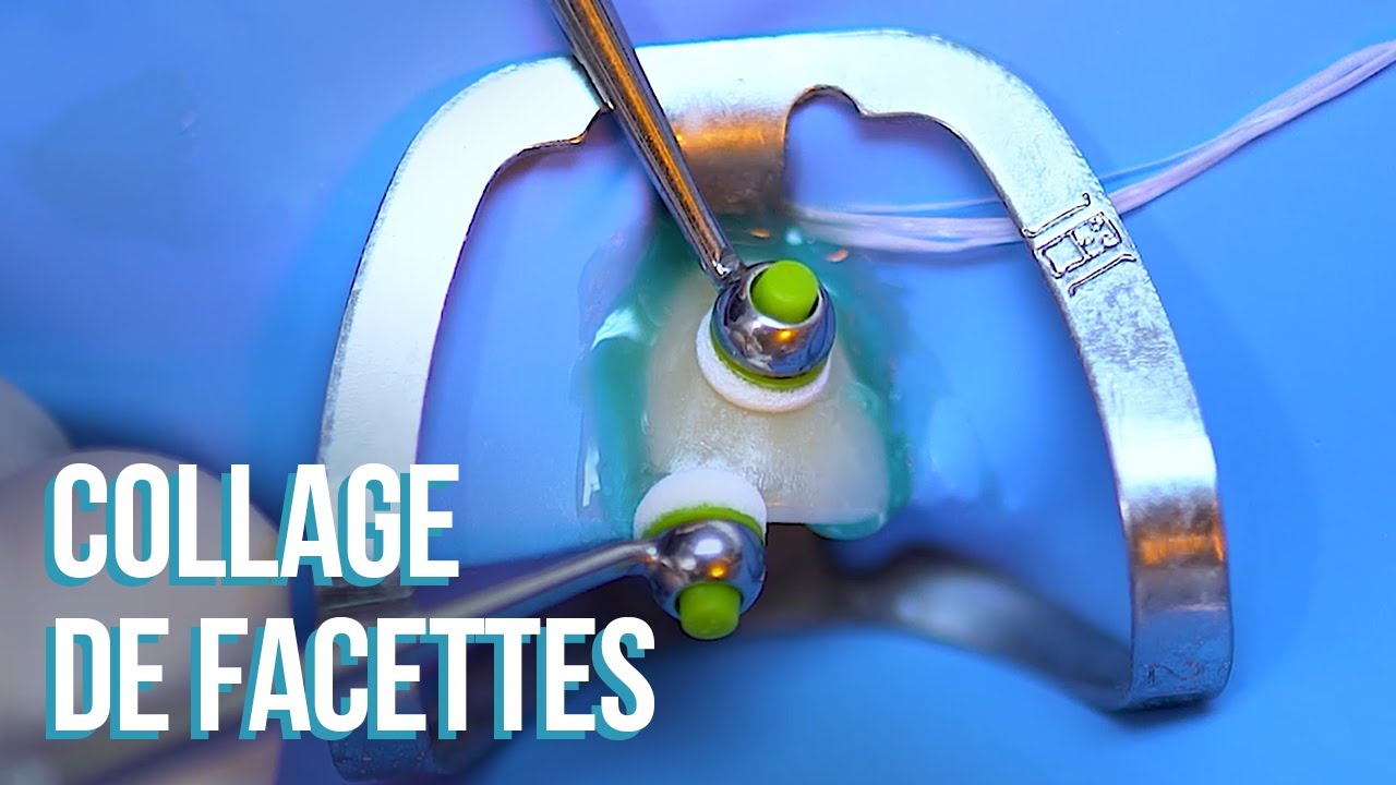 😍 Comment bien réussir son collage de facettes ? - YouTube