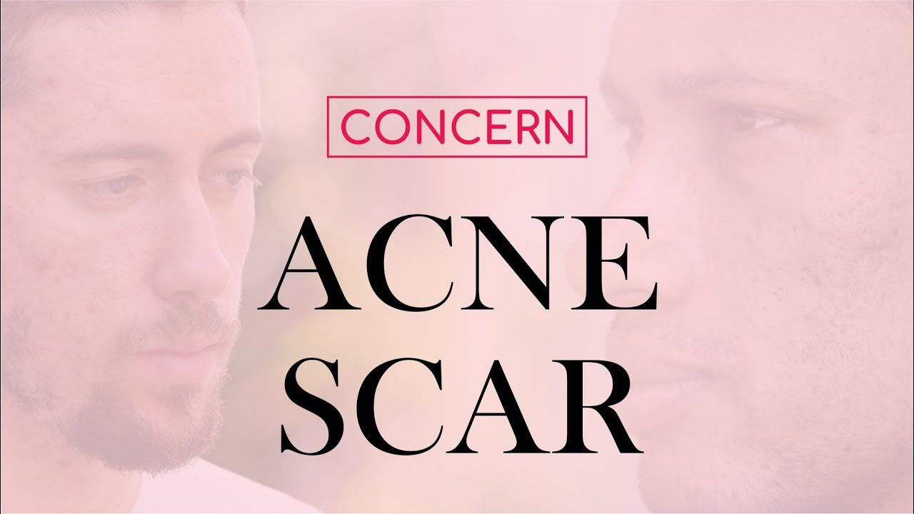 Acne Scar Transformation | Proven Results | Sakhiya Skin Clinic - YouTube