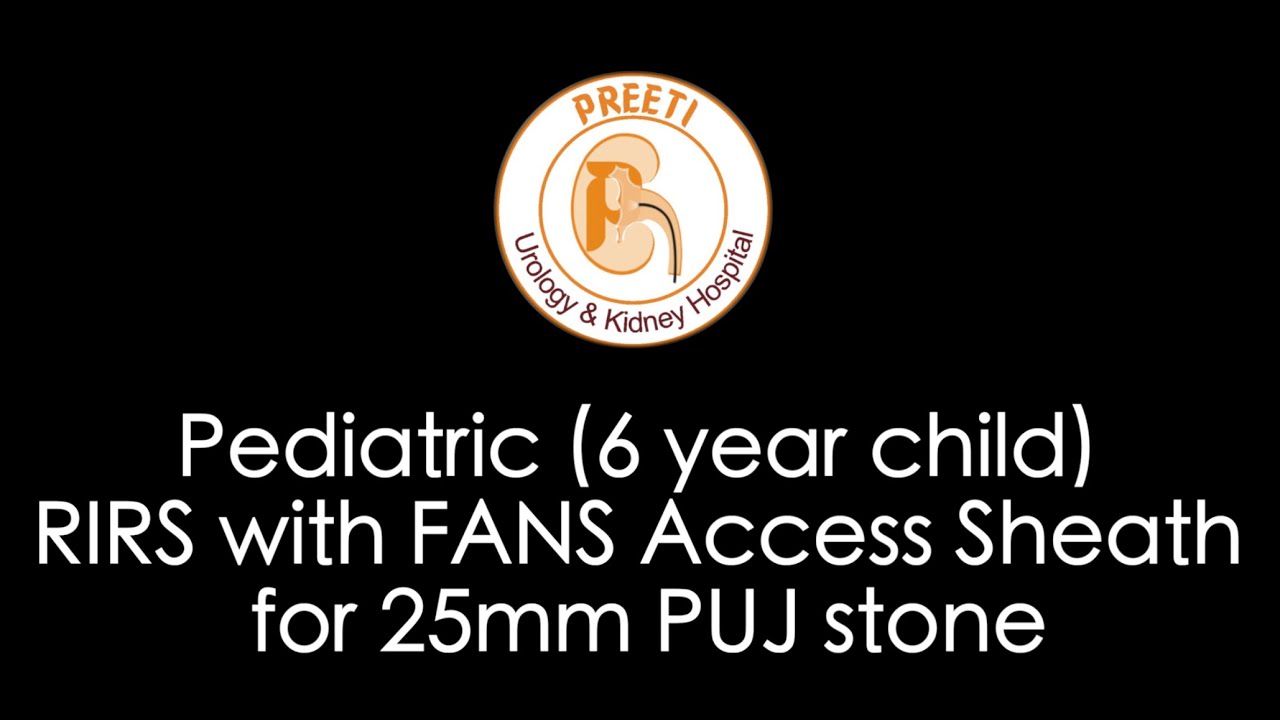 Pediatric (6 year child)RIRS with FANS Access Sheath for 25mm PUJ stone ...
