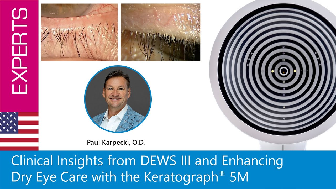 Clinical Insights from DEWS III and Enhancing Dry Eye Care with the ...