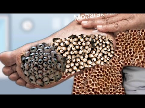 ASMR Remove a treatment 🚨 🚨 Maggot & Worm Infected Leg &Foot Severely ...