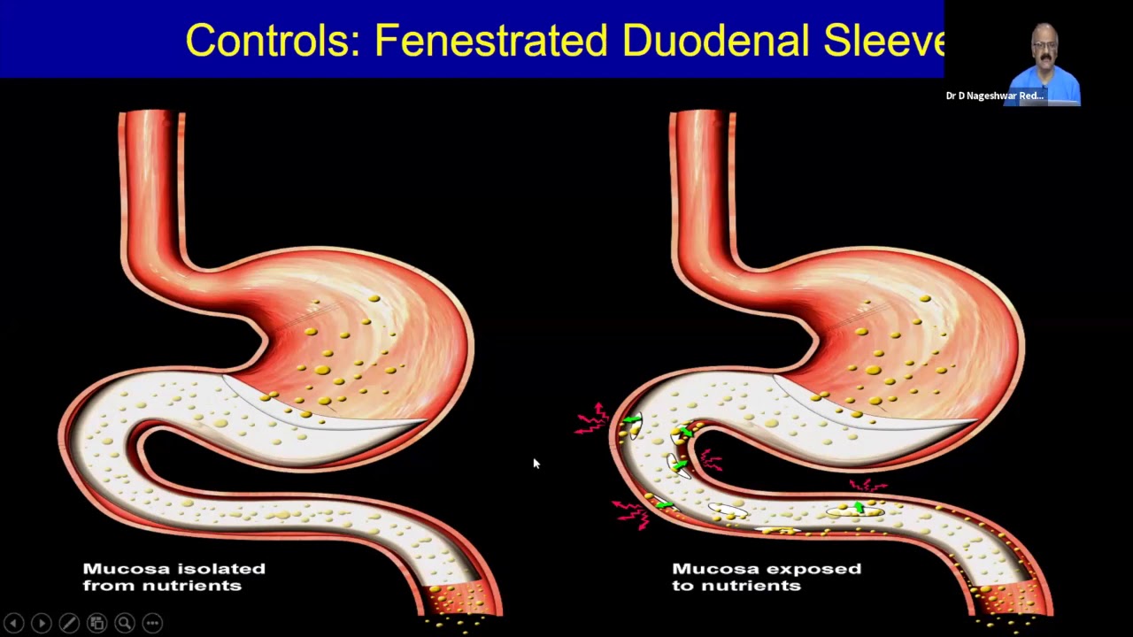 Metabolic Endoscopy - Prof. Nageshwar Reddy - YouTube