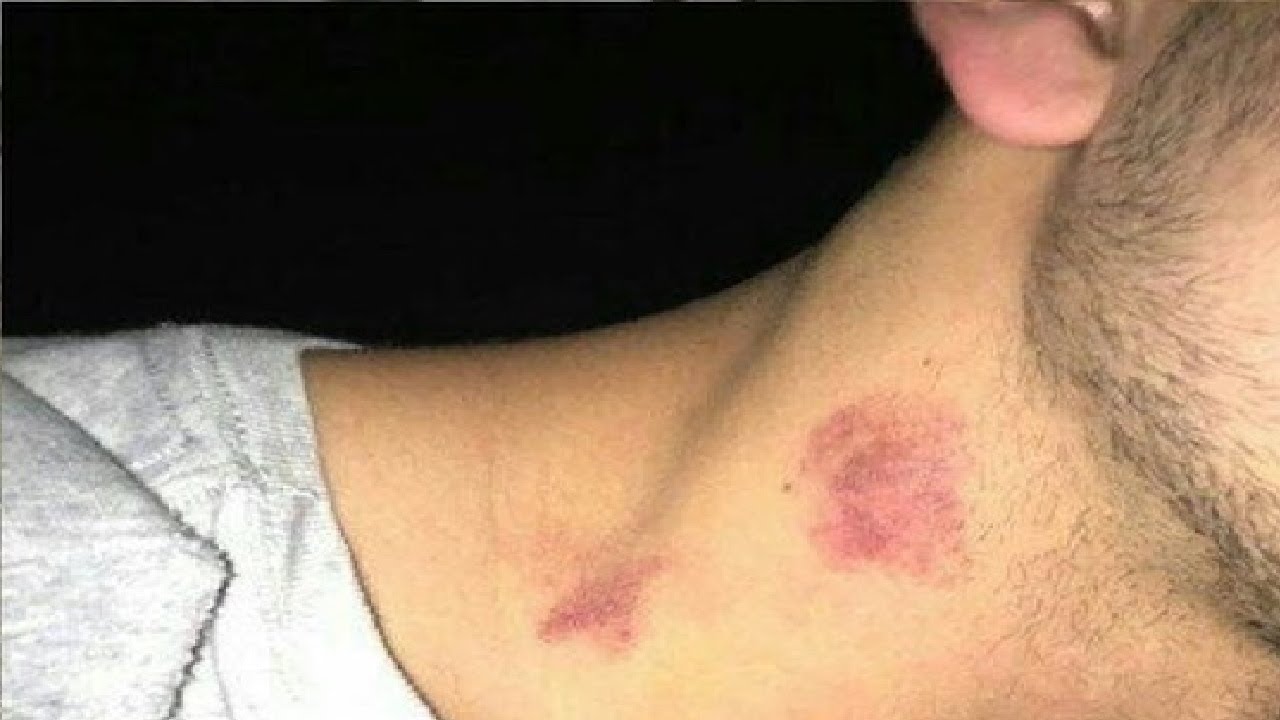 how to get rid of a hickey with a spoon easy - YouTube