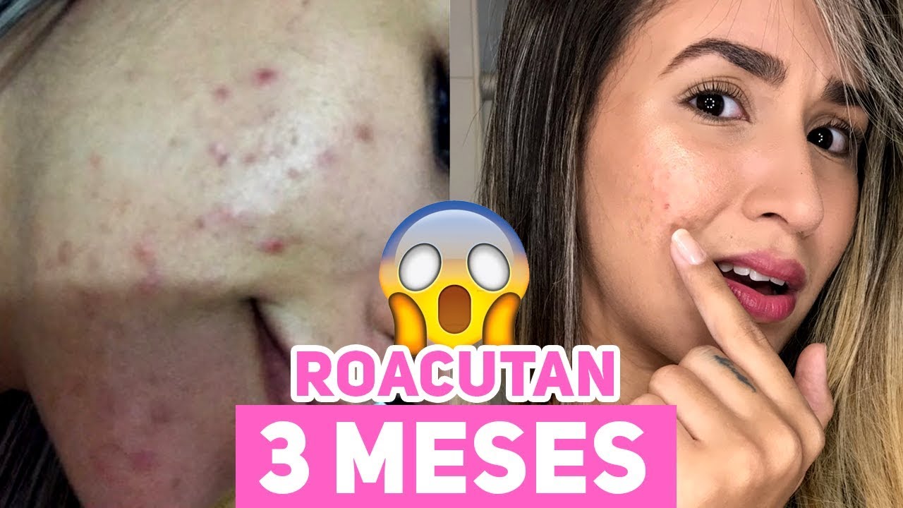 ROACUTAN: 3 MESES DE TRATAMENTO - YouTube
