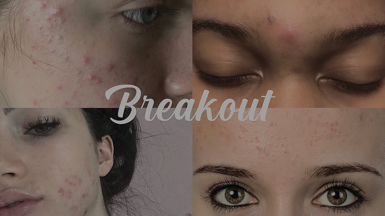 THIS IS WHY YOUR SKIN IS BREAKING OUT!! - YouTube