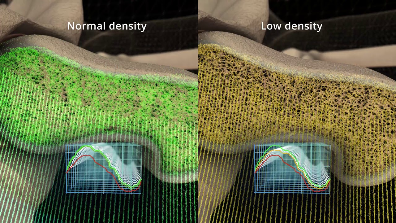 Echolight: REMS Technology Femur - YouTube
