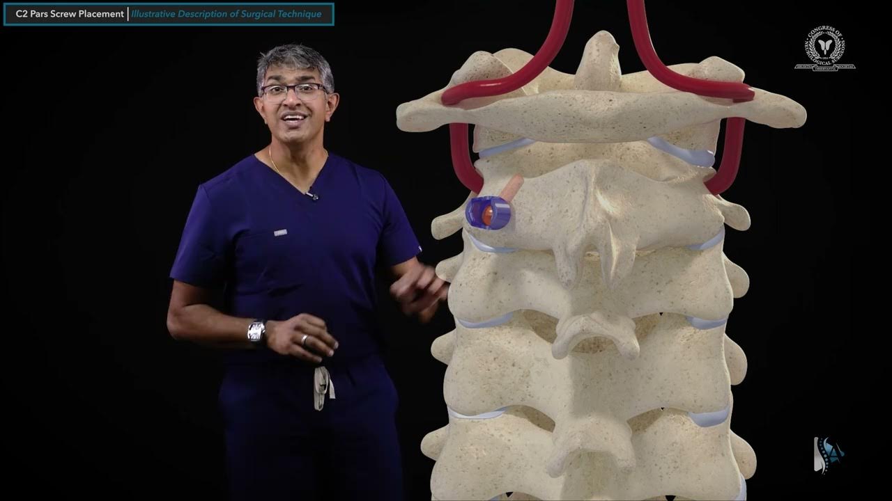Surgical Techniques: C2 Pars Screw Placement - YouTube