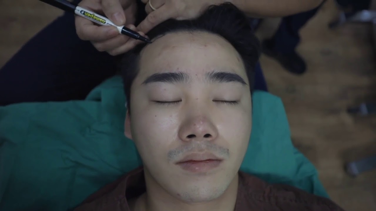 Hair Transplantation in Korea Ft Leo Chun | Seoul Guide Medical - YouTube