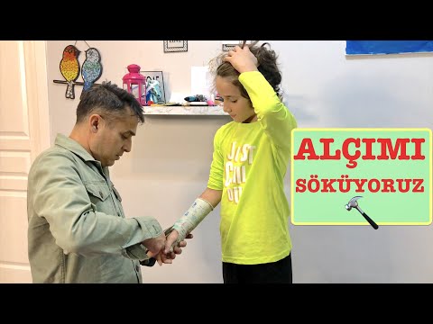 ALÇIMI SÖKÜYORUZ. EL BİLEĞİMDEKİ KIRIK 3 HAFTADIR ALÇIDAYDI. HÜSO