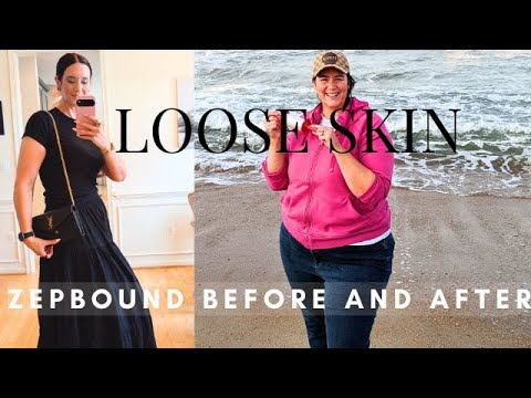 *shocking* -107LB ZEPBOUND BEFORE AND AFTER WEIGHT LOSS LOOSE SKIN ...