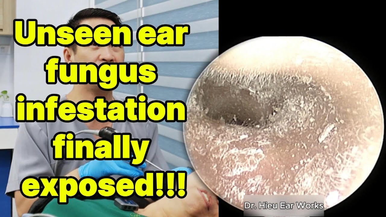 Unseen ear fungus infestation finally exposed | ear cleaning | ASMR ...