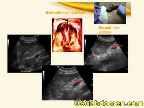 Normal USG abdomen report - YouTube