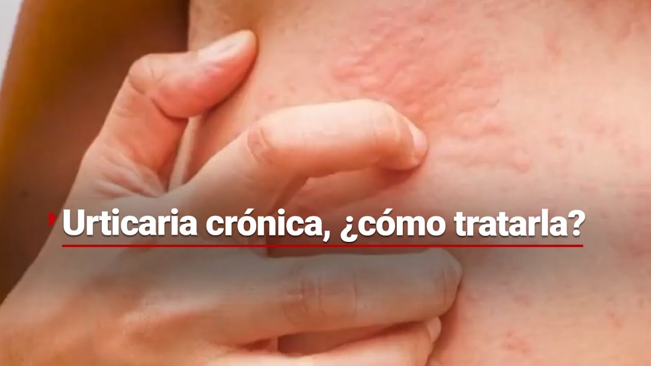ComezÓn Por Todas Partes ¿qué Puede Provocar La Urticaria Crónica Y