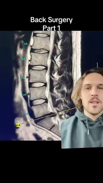 How I fixed my herniated disc. Watch my progress and see what to expect if you have back pain ...